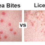 Flea Bites on Humans