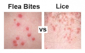 Flea Bites vs Lice - How Do You Tell Them Apart? - FLEABITES